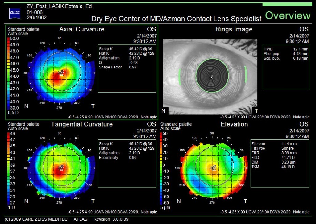 Post Lasik Ectasia Treatment For Post LASIK Side Effects Post Lasik Ectasia Treatment For Post LASIK Side Effects